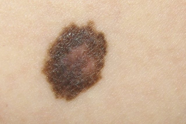 Cancer De La Peau Les Applications Identifiant Des Mélanomes Peu